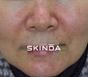 분당피부과혈관치료를 위한 브이빔 프리마 레이저의 효과 네이버 블로그